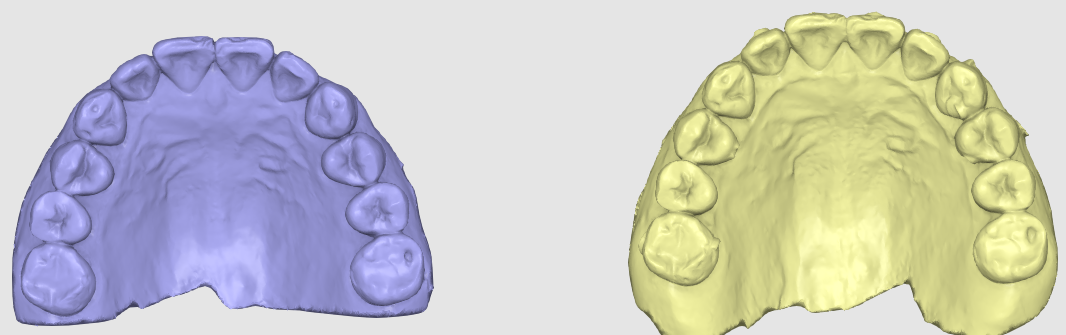 Tran T. – Class IIIB, Molar Class I with Bilateral Cross Bite ...