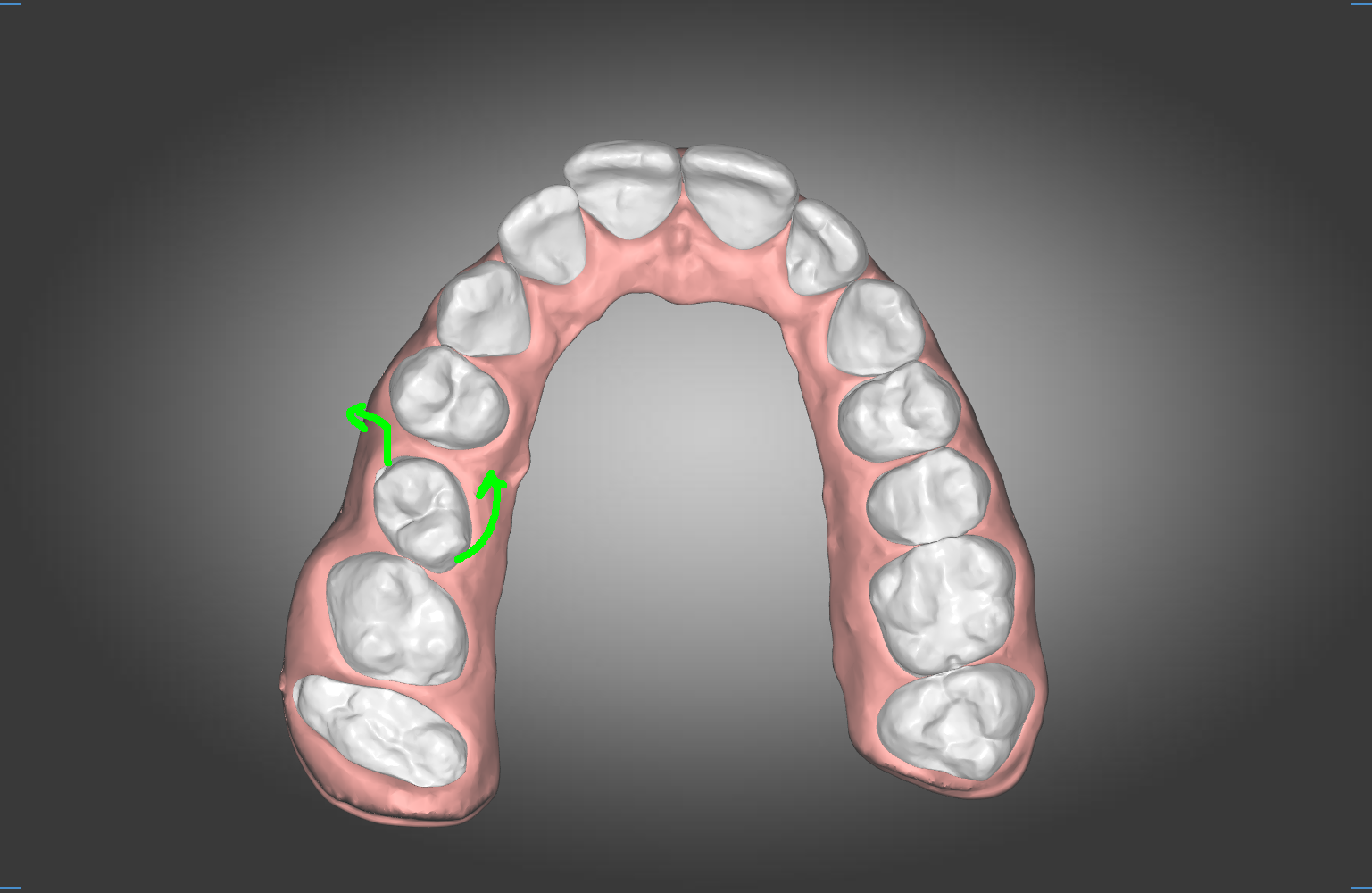 Brody D. – Age 29 Cross Bite, Asymmetric multiple missing teeth upper ...