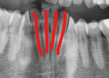 Brody D. – Age 29 Cross Bite, Asymmetric multiple missing teeth upper ...