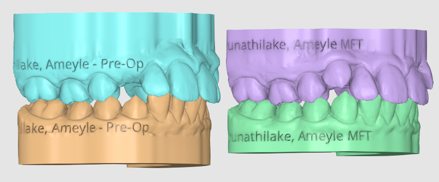 Ameyle K. 11 years old- Class II div 2 – Mixed Dentition with moderate ...