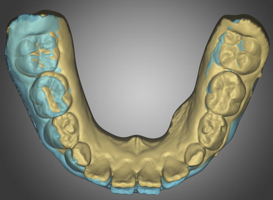 Lucas L – 8yo – Close Diastema before MFT – Class II div 1 and 2 Mixed ...