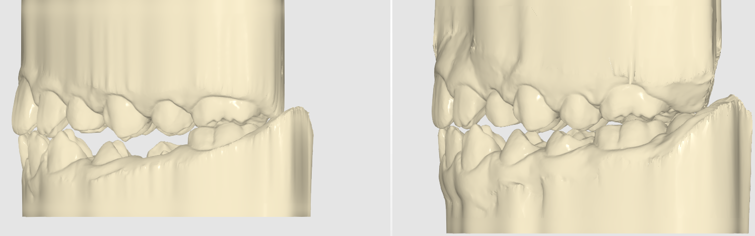 Alexander M. Class IIIB – ADAPTIVE ORTHODONTICS
