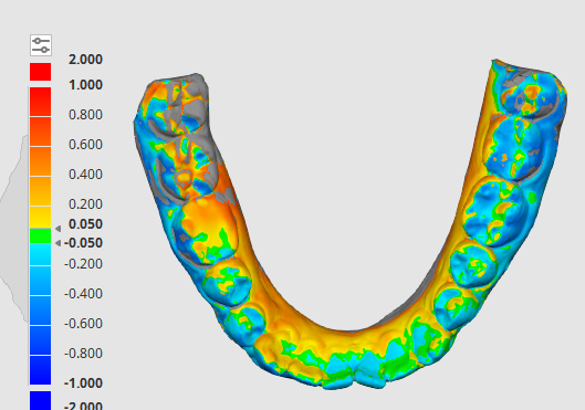 Nada K. – MFT/SA – Class IIIB with anterior open bite tongue thrust ...