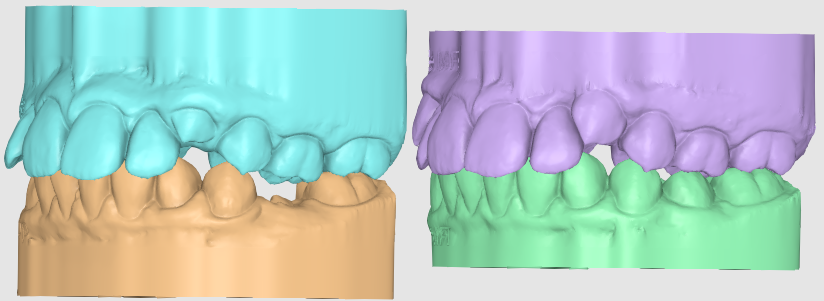 Ameyle K. 11 years old- Class II div 2 – Mixed Dentition with moderate ...