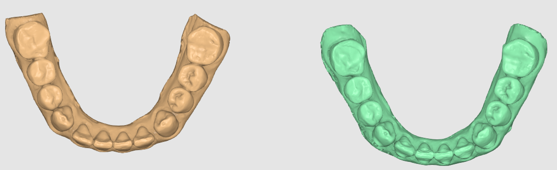 Tran T. – Class IIIB, Molar Class I with Bilateral Cross Bite ...