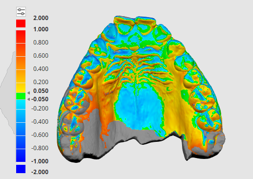 Nada K. – MFT/SA – Class IIIB with anterior open bite tongue thrust ...