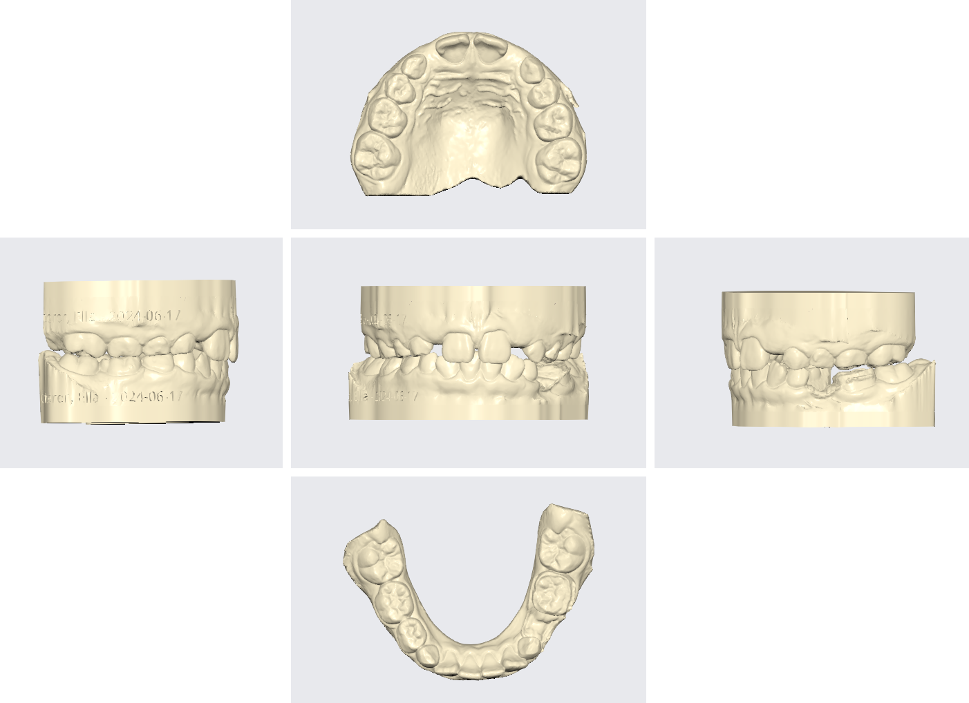 Ella C. – RME + Myobrace – Mixed Dentition, Class II Div 1 ...