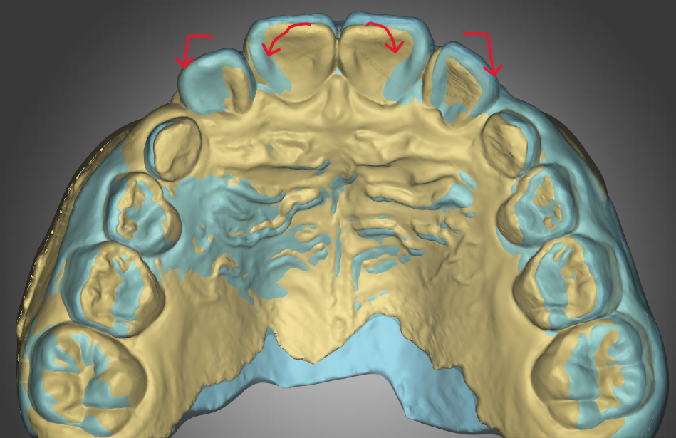 Lucas L – 8yo – Close Diastema before MFT – Class II div 1 and 2 Mixed ...