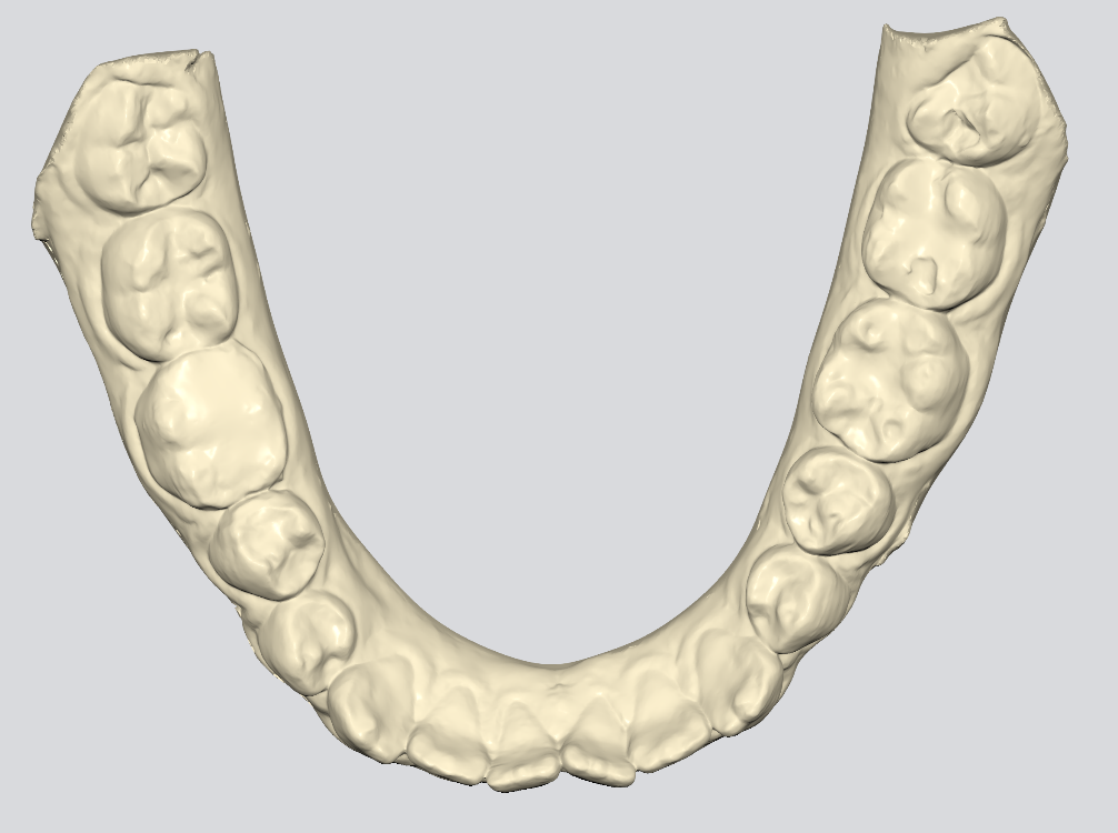 Nada K. – MFT/SA – Class IIIB with anterior open bite tongue thrust ...