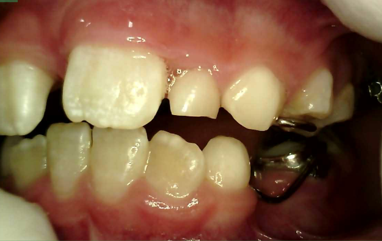 Ella C. – RME + Myobrace – Mixed Dentition, Class II Div 1 ...