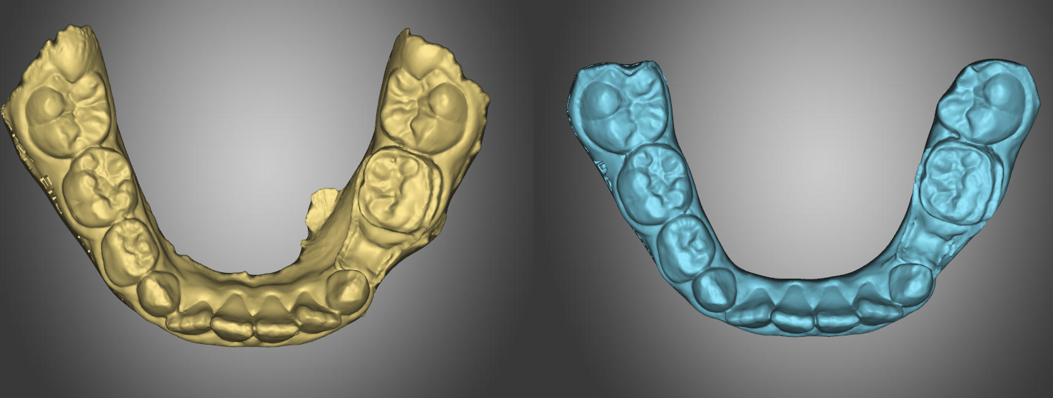 Ella C. – RME + Myobrace – Mixed Dentition, Class II Div 1 ...