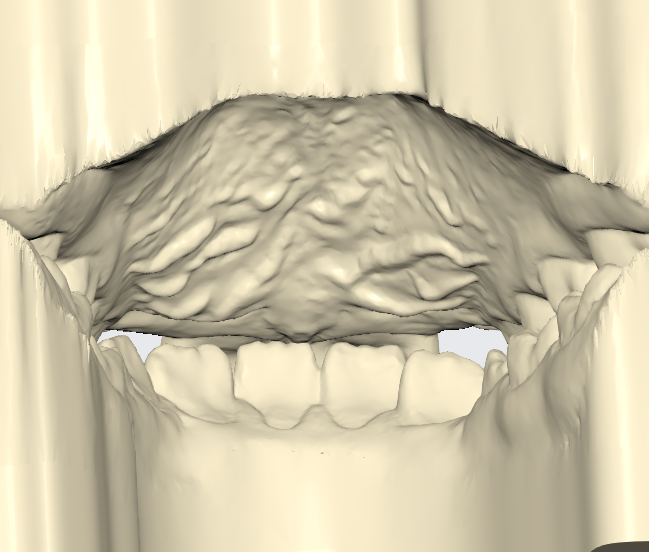 Charlie C. – MFT – Class II Div 2 – Deep Bite – ADAPTIVE ORTHODONTICS