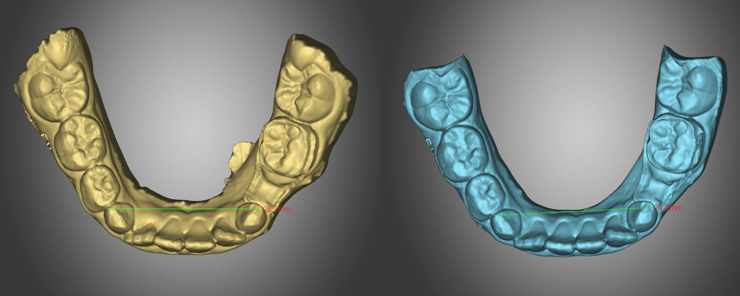 Ella C. – RME + Myobrace – Mixed Dentition, Class II Div 1 ...