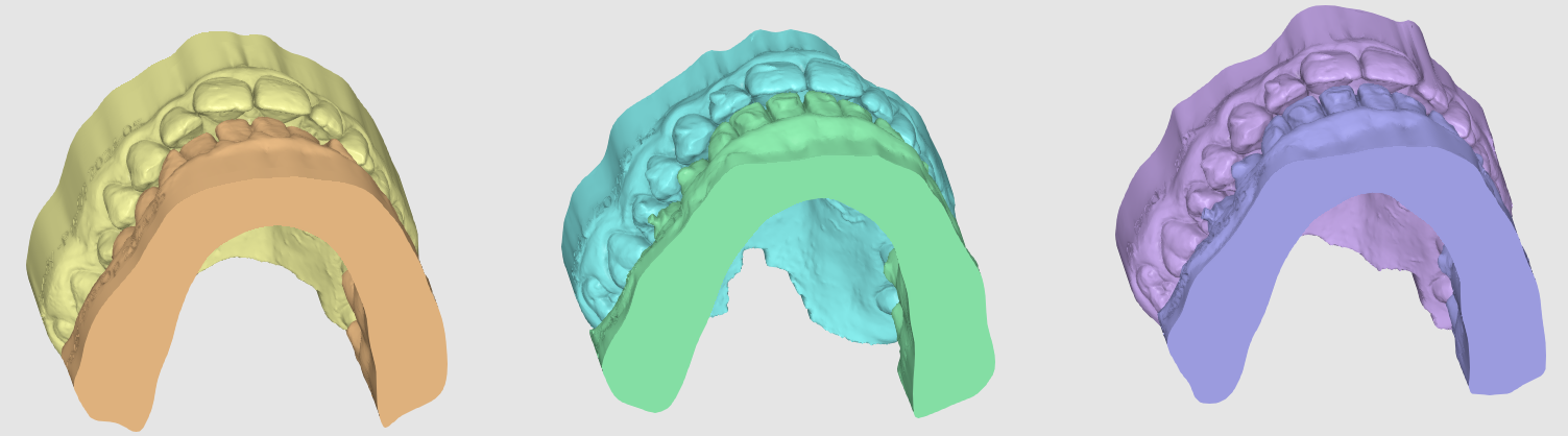 Brody D. – Age 29 Cross Bite, Asymmetric multiple missing teeth upper ...