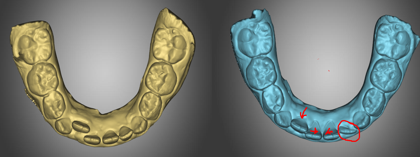 Liam.E – Rapid Maxillary Expansion, Myofunctional Therapy – ADAPTIVE ...