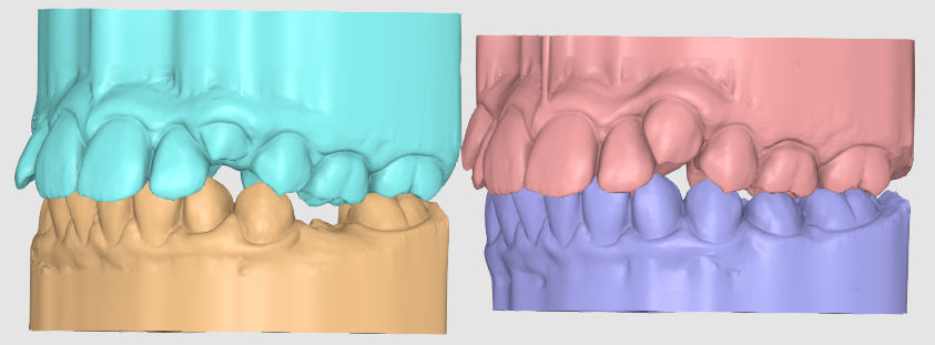 Ameyle K. 11 years old- Class II div 2 – Mixed Dentition with moderate ...