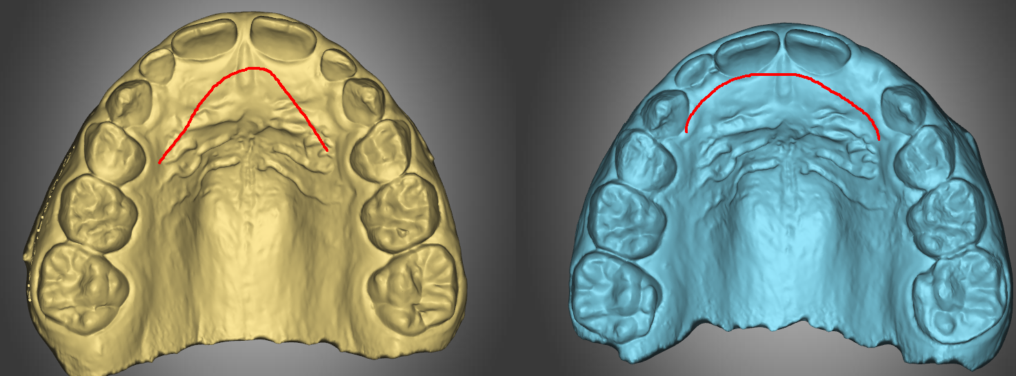 Liam.E – Rapid Maxillary Expansion, Myofunctional Therapy – ADAPTIVE ...
