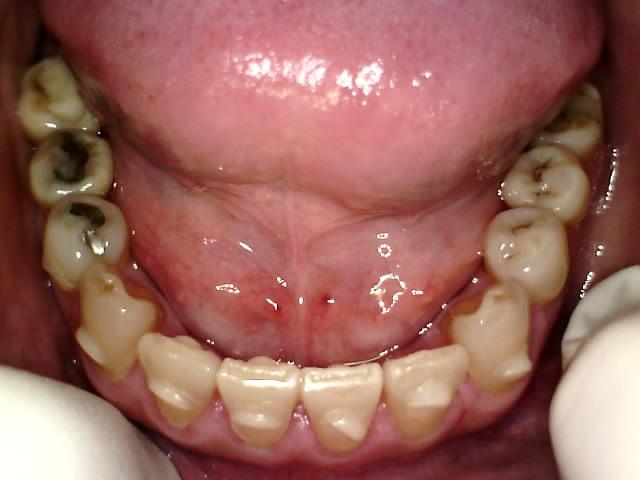 Tran T. – Class IIIB, Molar Class I with Bilateral Cross Bite ...