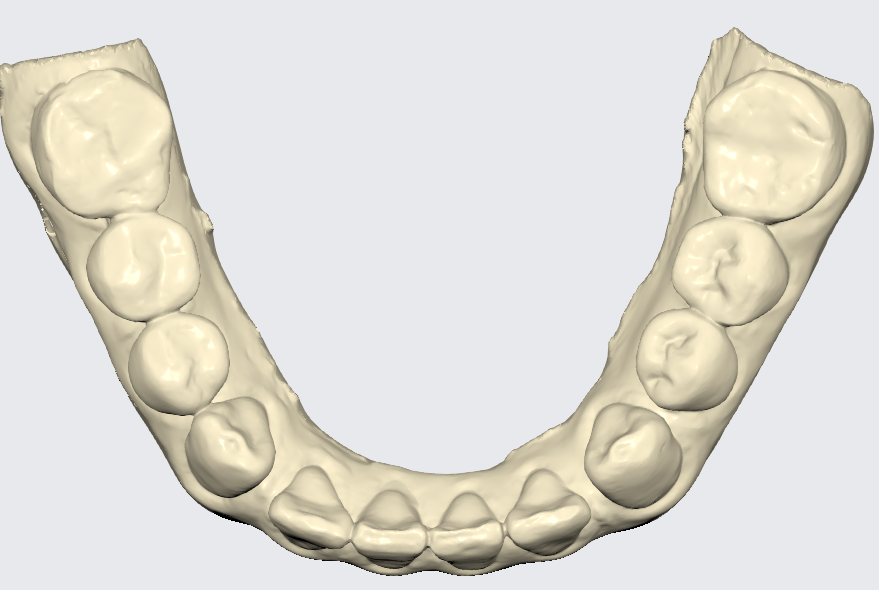 Tran T. – Class IIIB, Molar Class I with Bilateral Cross Bite ...