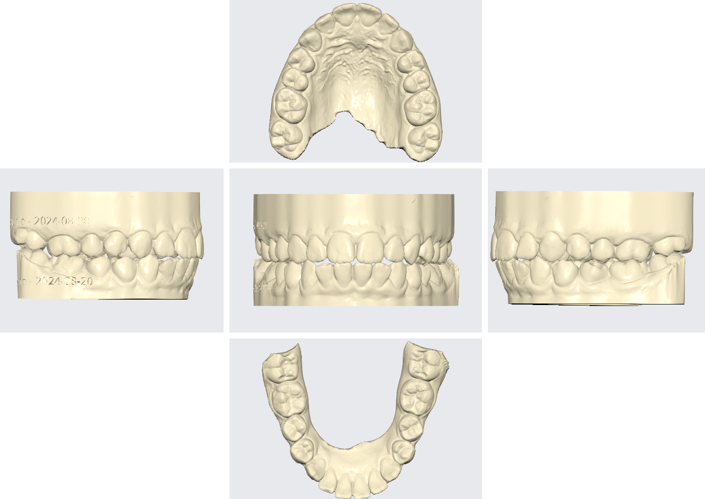 Sophie, P – MFT, mixed dentition, Class II Div 1 – ADAPTIVE ORTHODONTICS