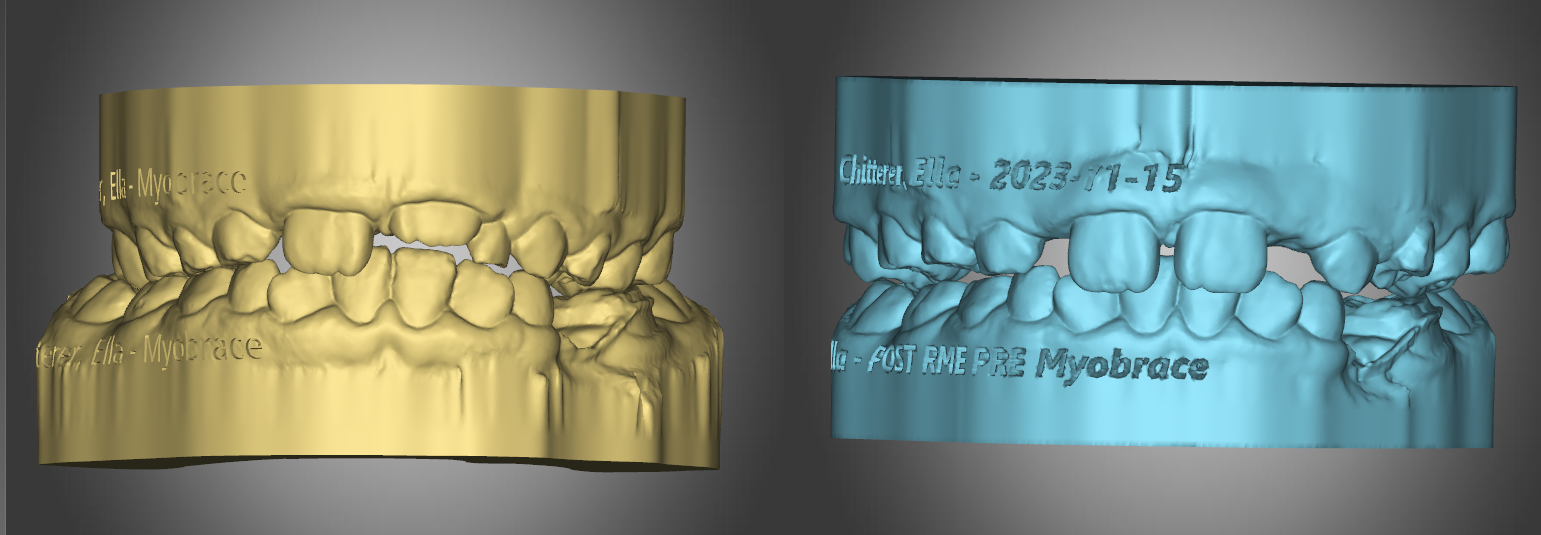 Ella C. – RME + Myobrace – Mixed Dentition, Class II Div 1 ...