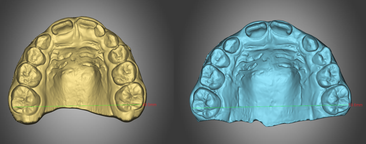 Ella C. – RME + Myobrace – Mixed Dentition, Class II Div 1 ...