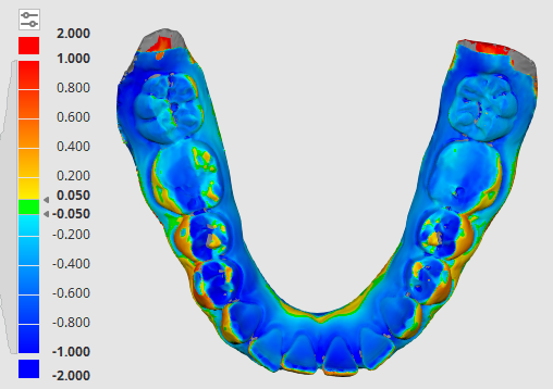 Eva B. – Deep Bite , Upper Central Diastema – ADAPTIVE ORTHODONTICS